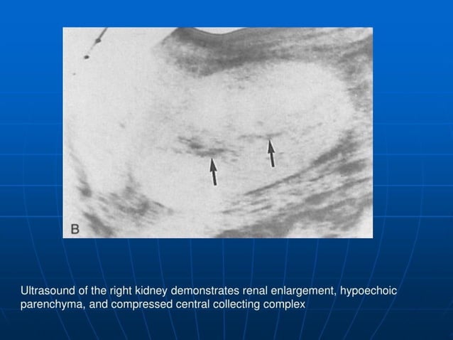 Kidney infections ppt.pdf acute and chronic...kidney abscess...renal ...