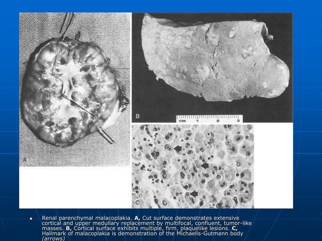 Kidney infections ppt.pdf acute and chronic...kidney abscess...renal ...