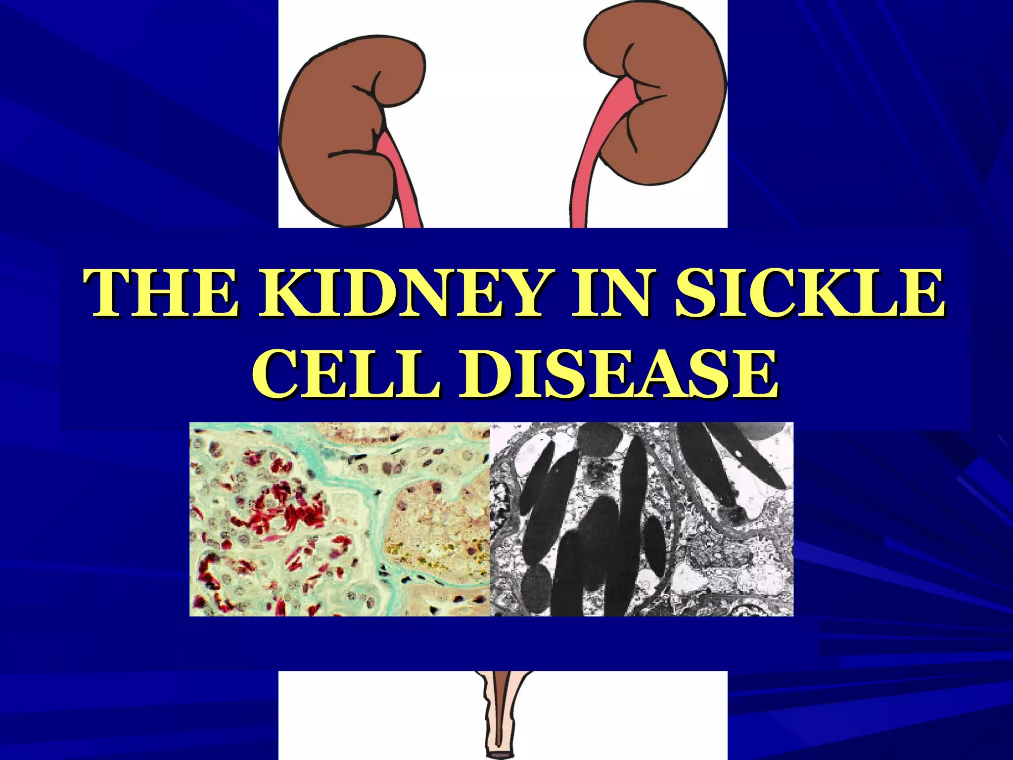 Kidney in sickle cell disease | PPT