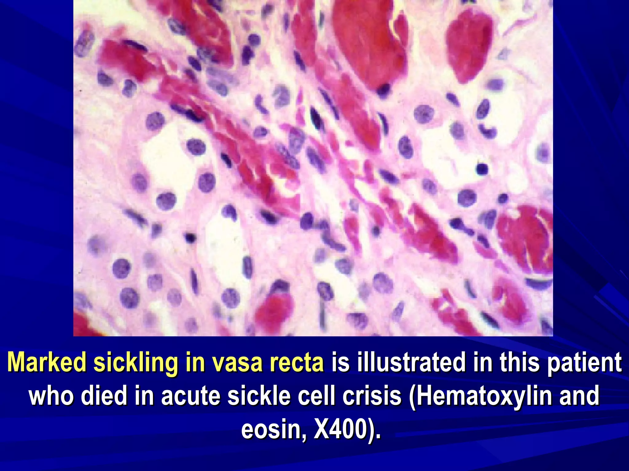 Kidney in sickle cell disease | PPT