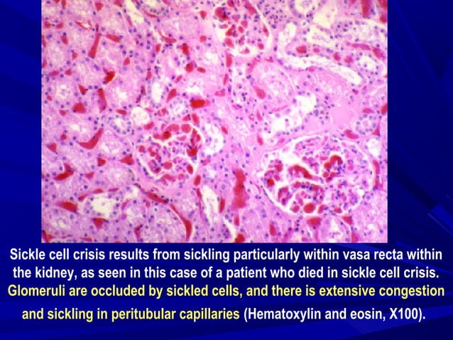 Kidney in sickle cell disease | PPT