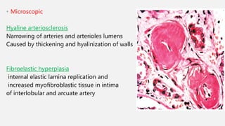 Nephrosclerosis | PPTX
