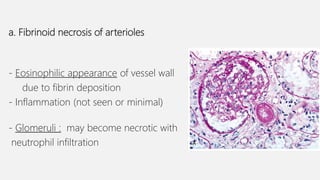 Nephrosclerosis | PPTX