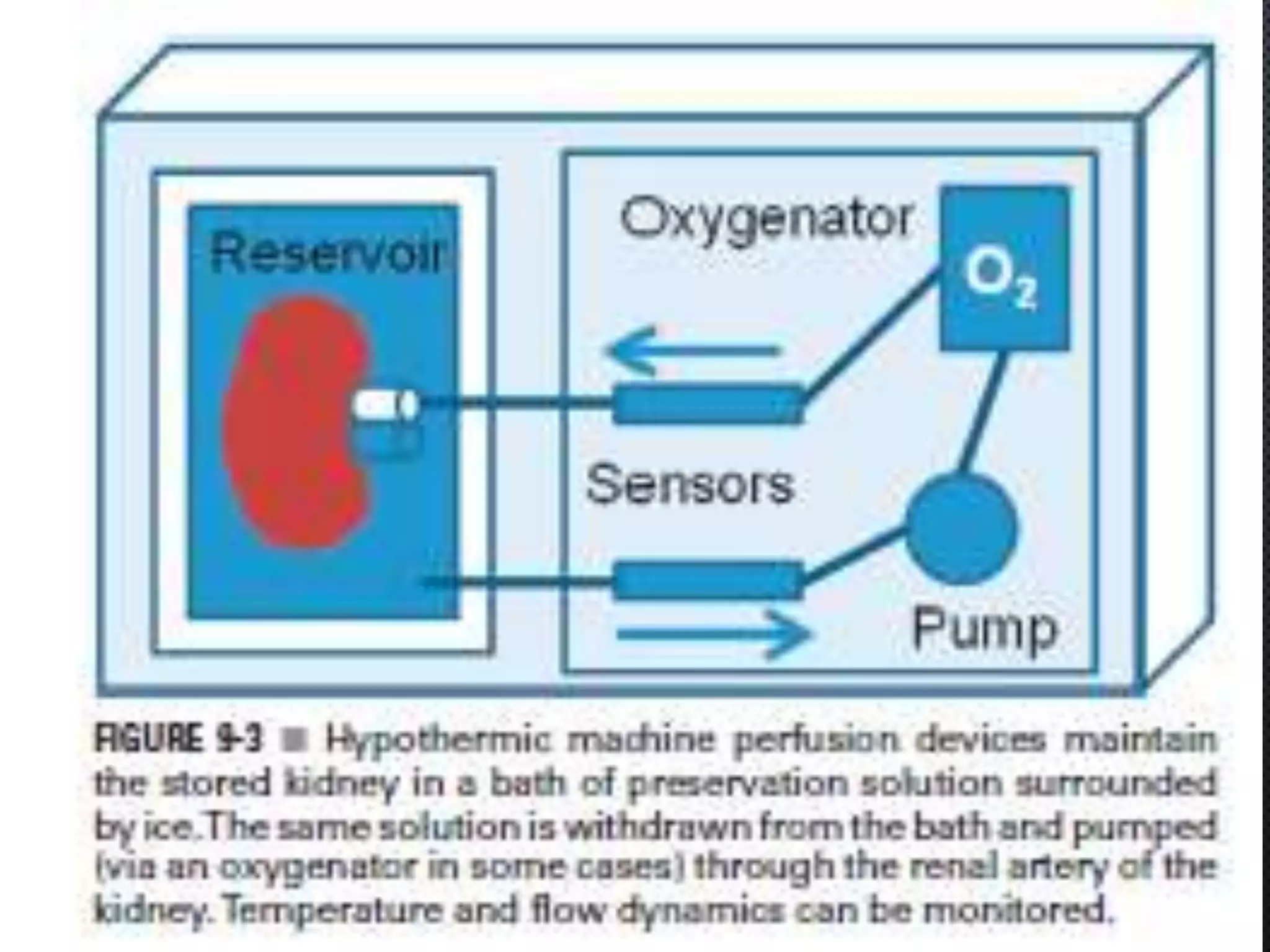 Kidney preservation storage and transport from cadaver donor | PPTX