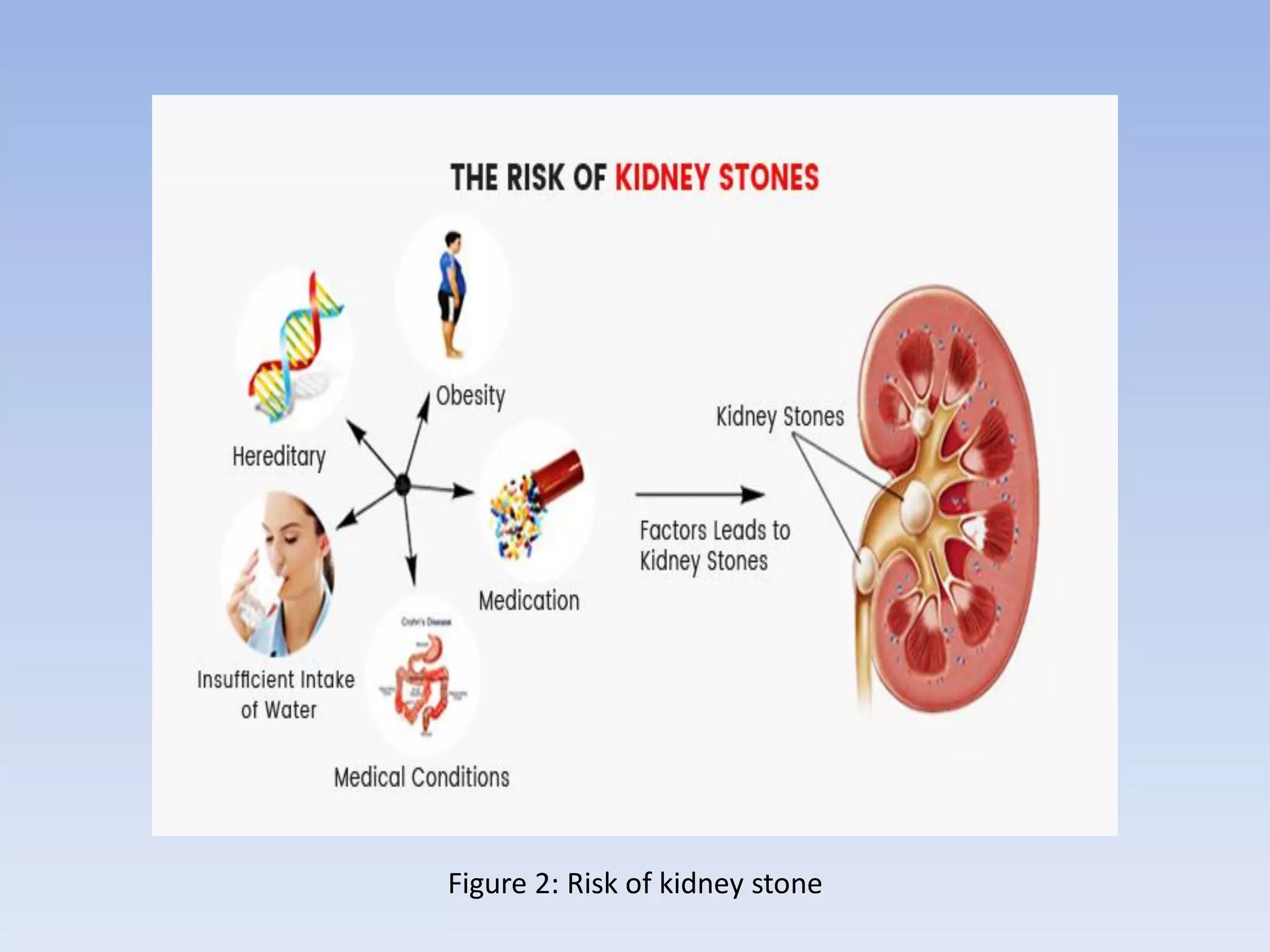 Kidney stone | PDF