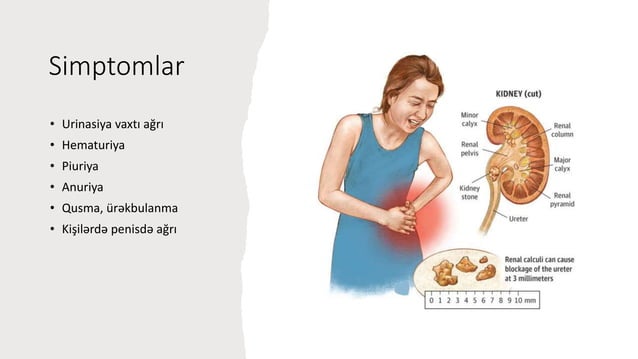Kidney Stone.pptx