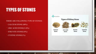 kidney stone.pptx