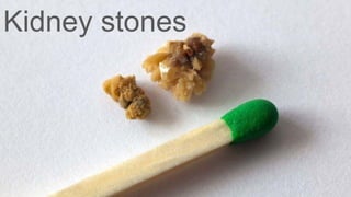 Kidney stone.pdf