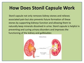 Kidney stone treatment without surgery | PPT