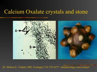 Kidney Stone Causes, Evaluation and Prevention | PPT