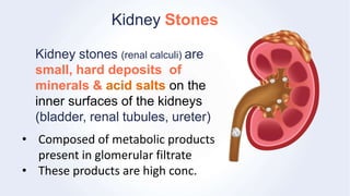 Kidney Stone Education for General - PPT English | PPTX