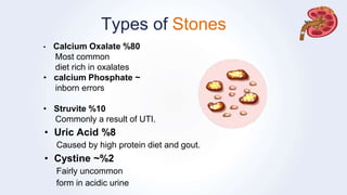 Kidney Stone Education for General - PPT English | PPTX