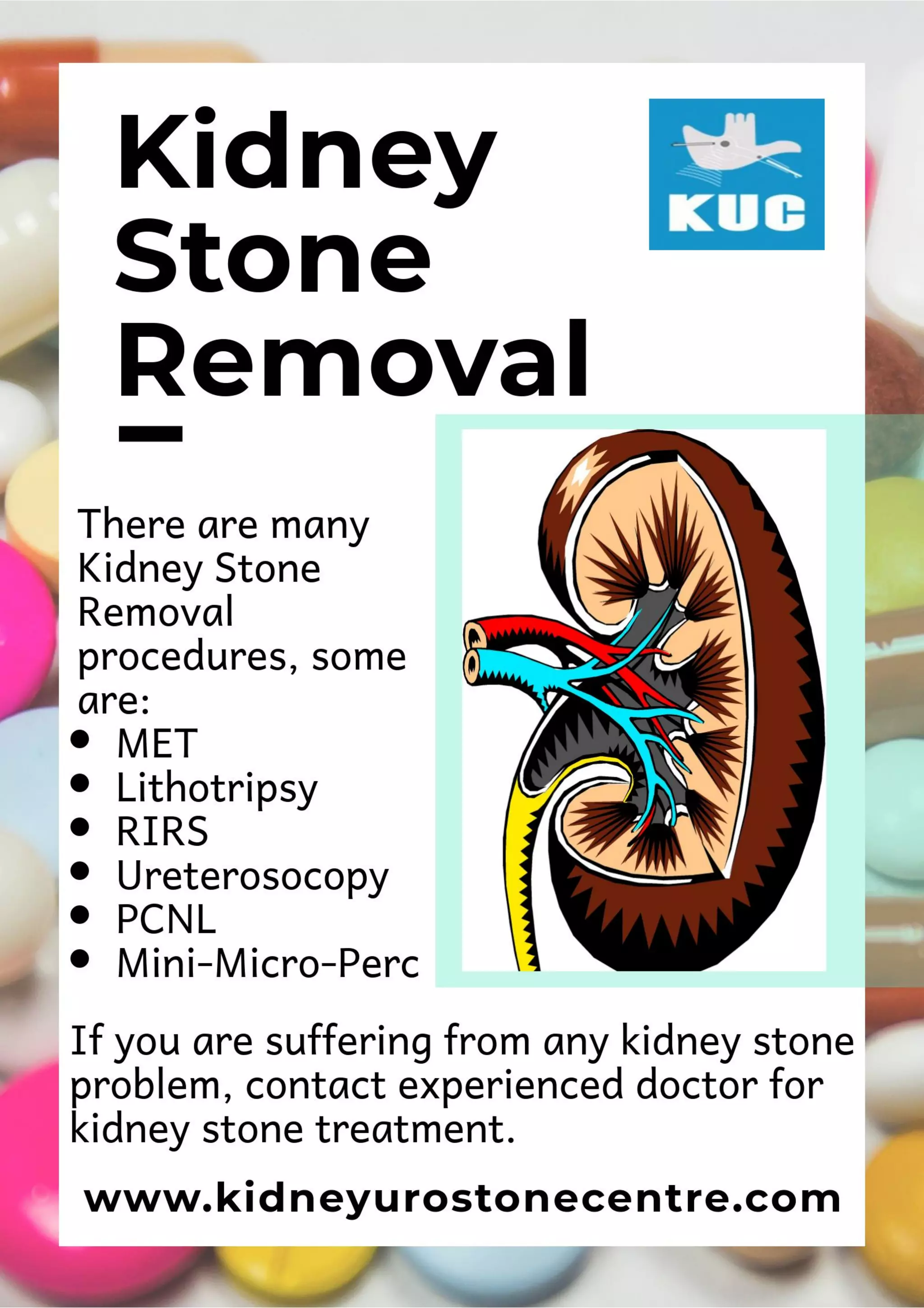 Kidney Stone Removal | PDF