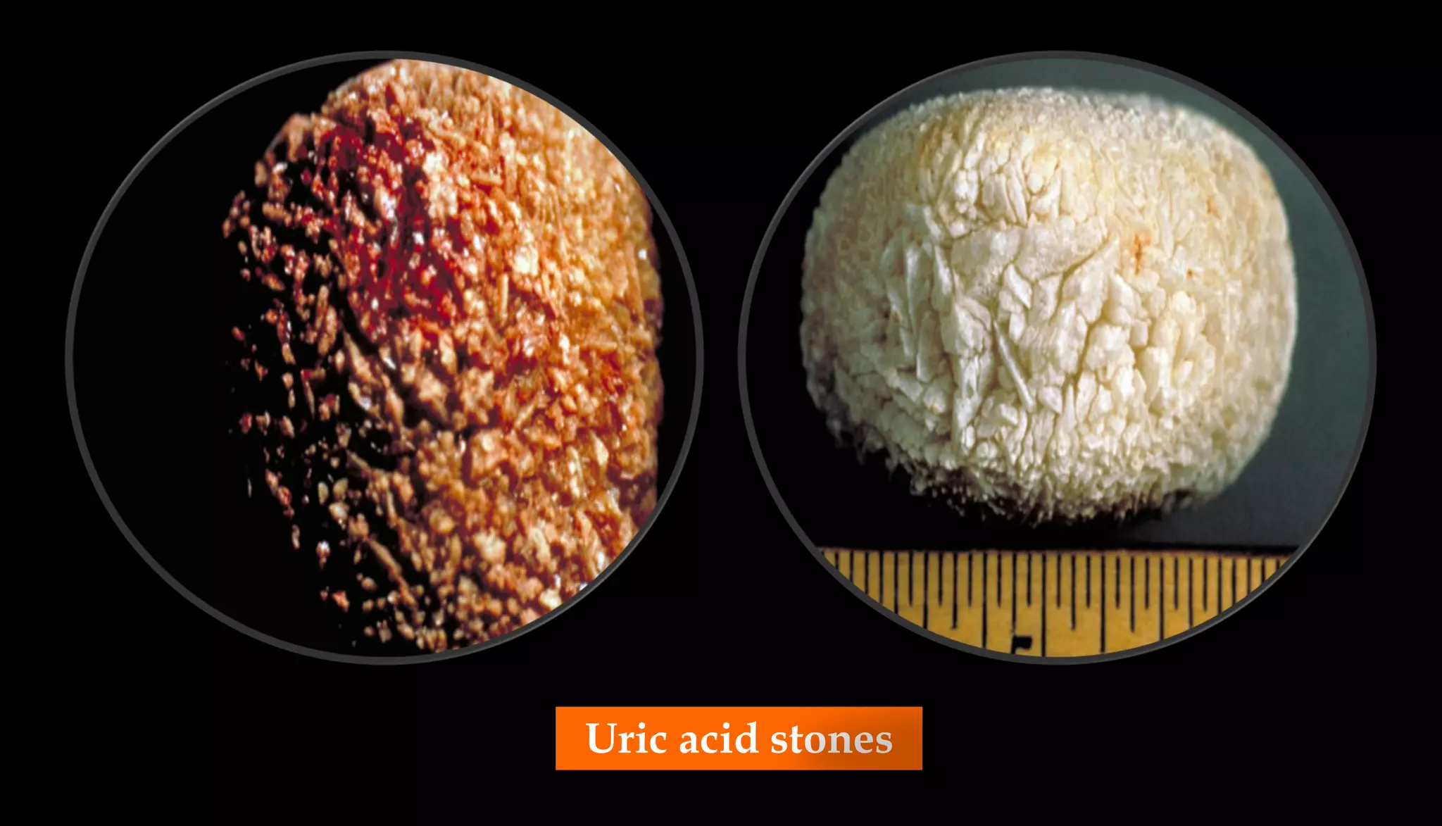 Pathophysiology of Kidney stones | PDF