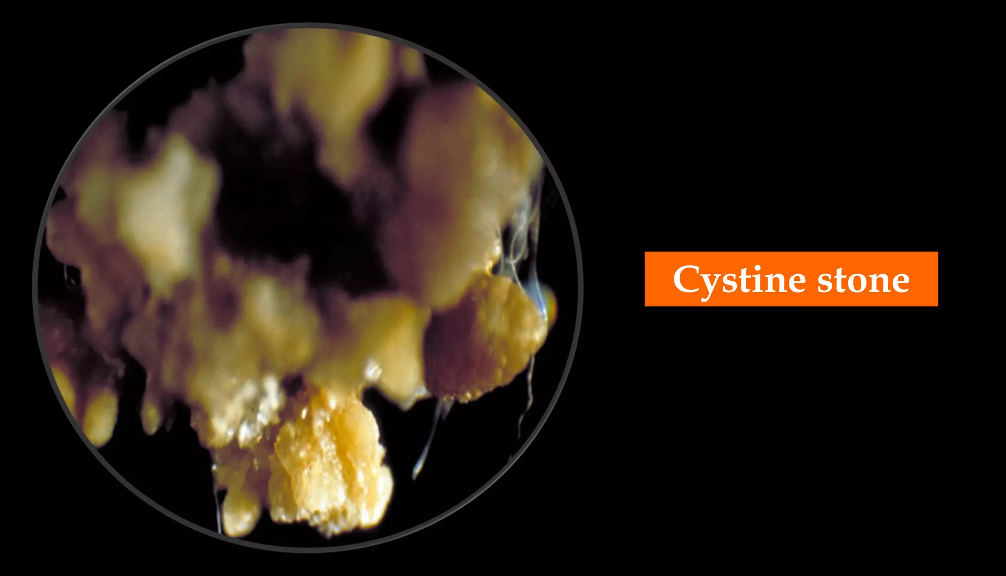 Pathophysiology of Kidney stones | PDF