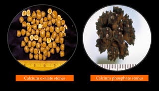 Pathophysiology of Kidney stones | PDF