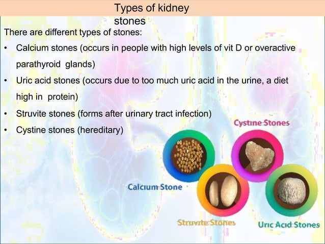 kidney stones types, complications, symptoms | PPTX | Chemistry | Science