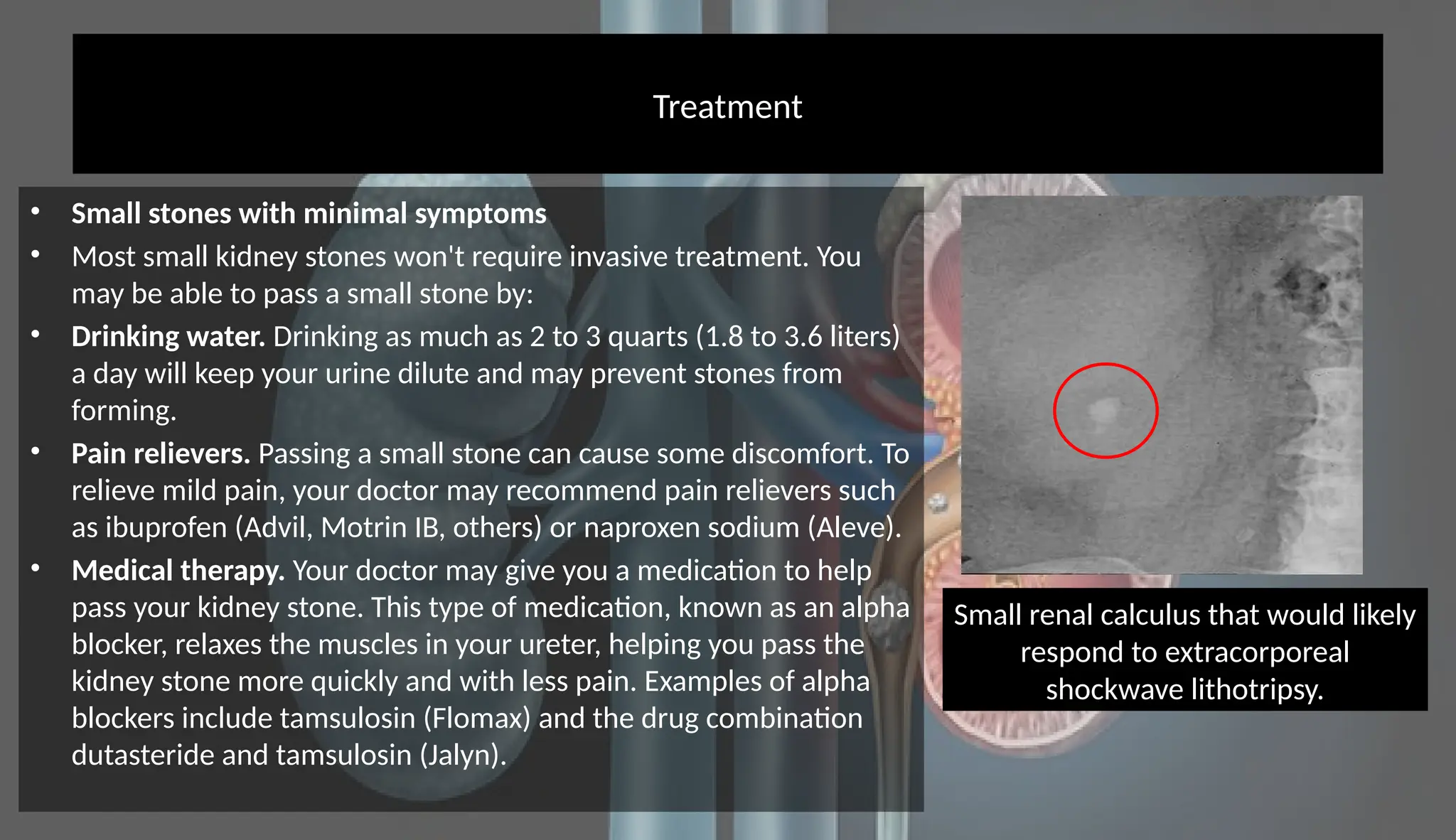 kidney stones introduction and patho.pptx