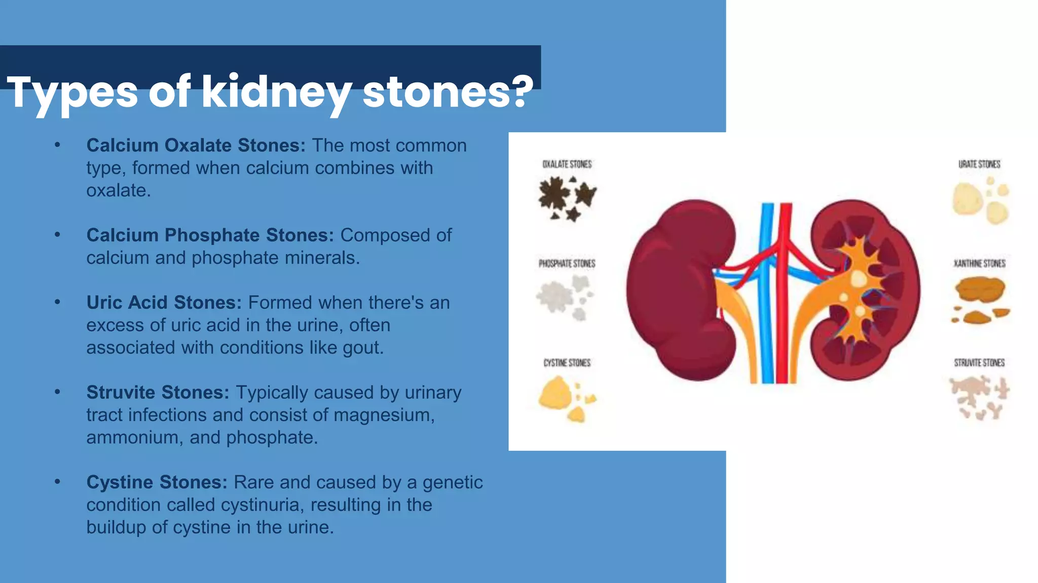 Kidney Stones Causes, Symptoms and treatment options.pptx