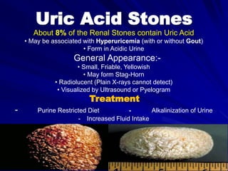 Kidney Stones HSSC II LBISE Chap. 15 | PPT