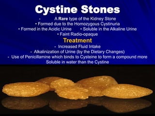 Kidney Stones HSSC II LBISE Chap. 15 | PPT