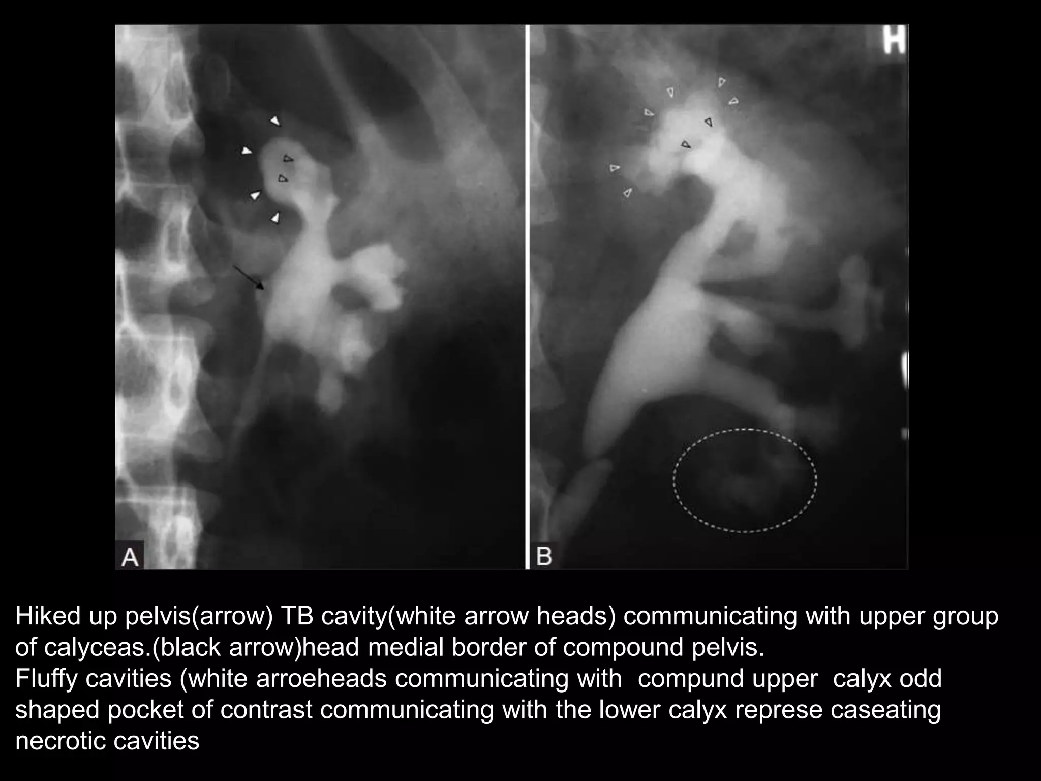 IMAGING FEATURES IN RENAL TUBERCULOSIS | PPTX