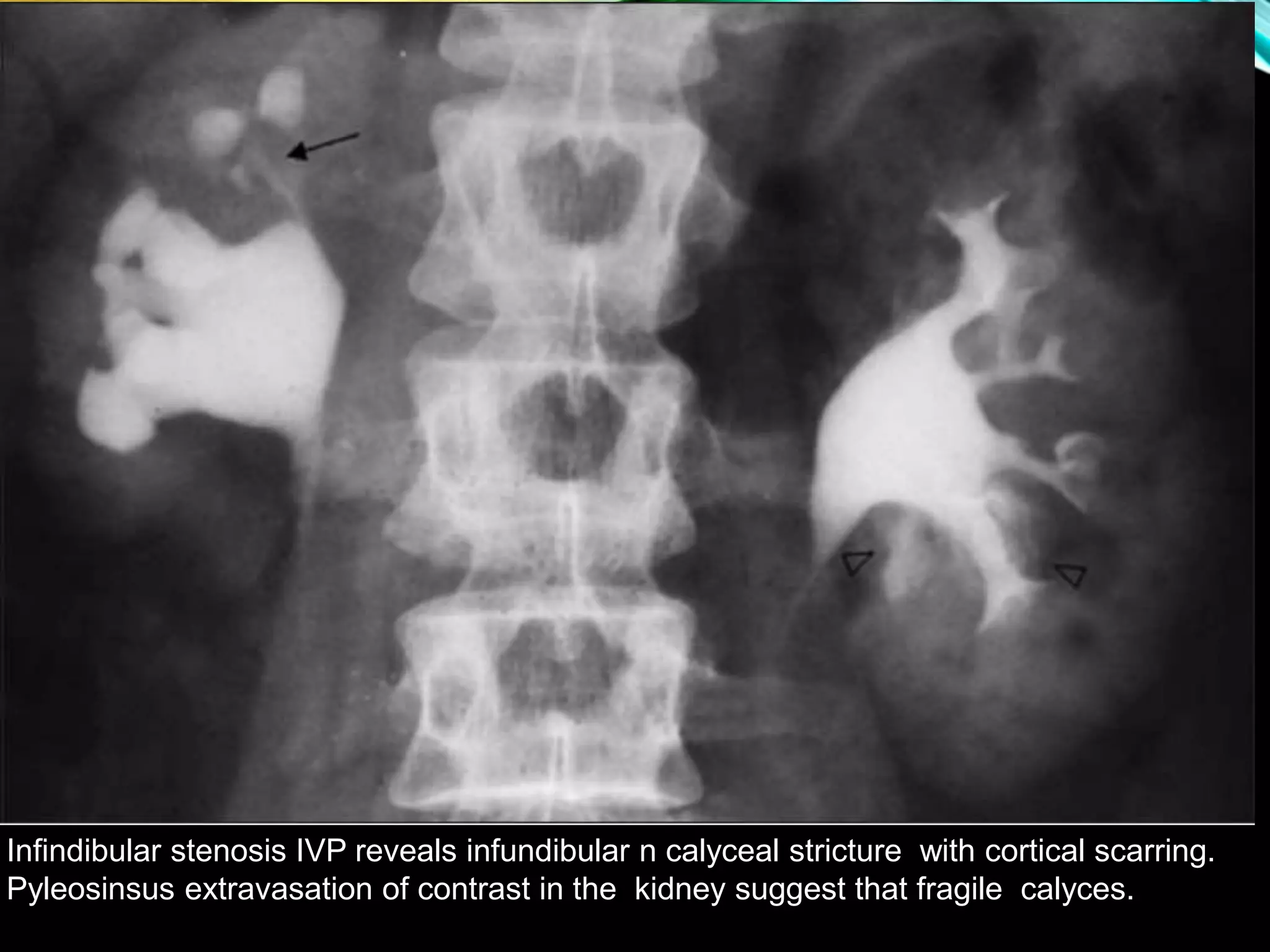 IMAGING FEATURES IN RENAL TUBERCULOSIS | PPTX