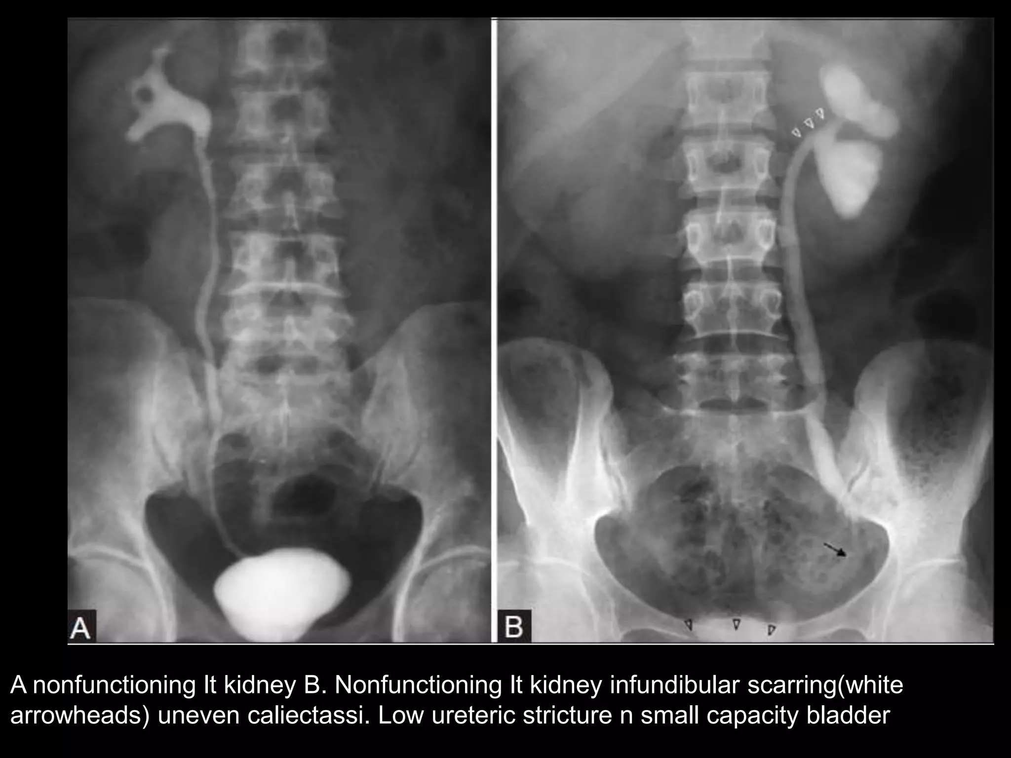 IMAGING FEATURES IN RENAL TUBERCULOSIS | PPTX