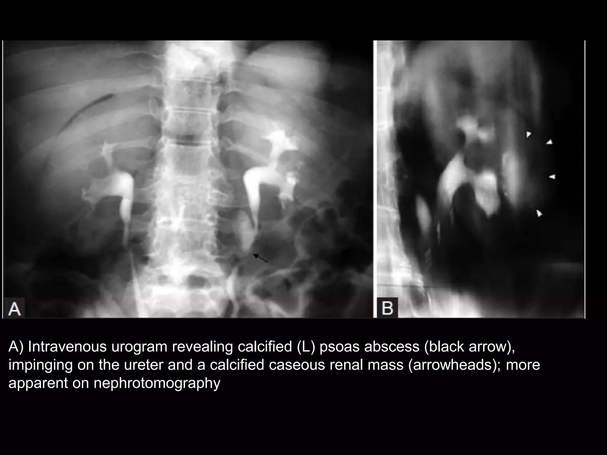 IMAGING FEATURES IN RENAL TUBERCULOSIS | PPTX