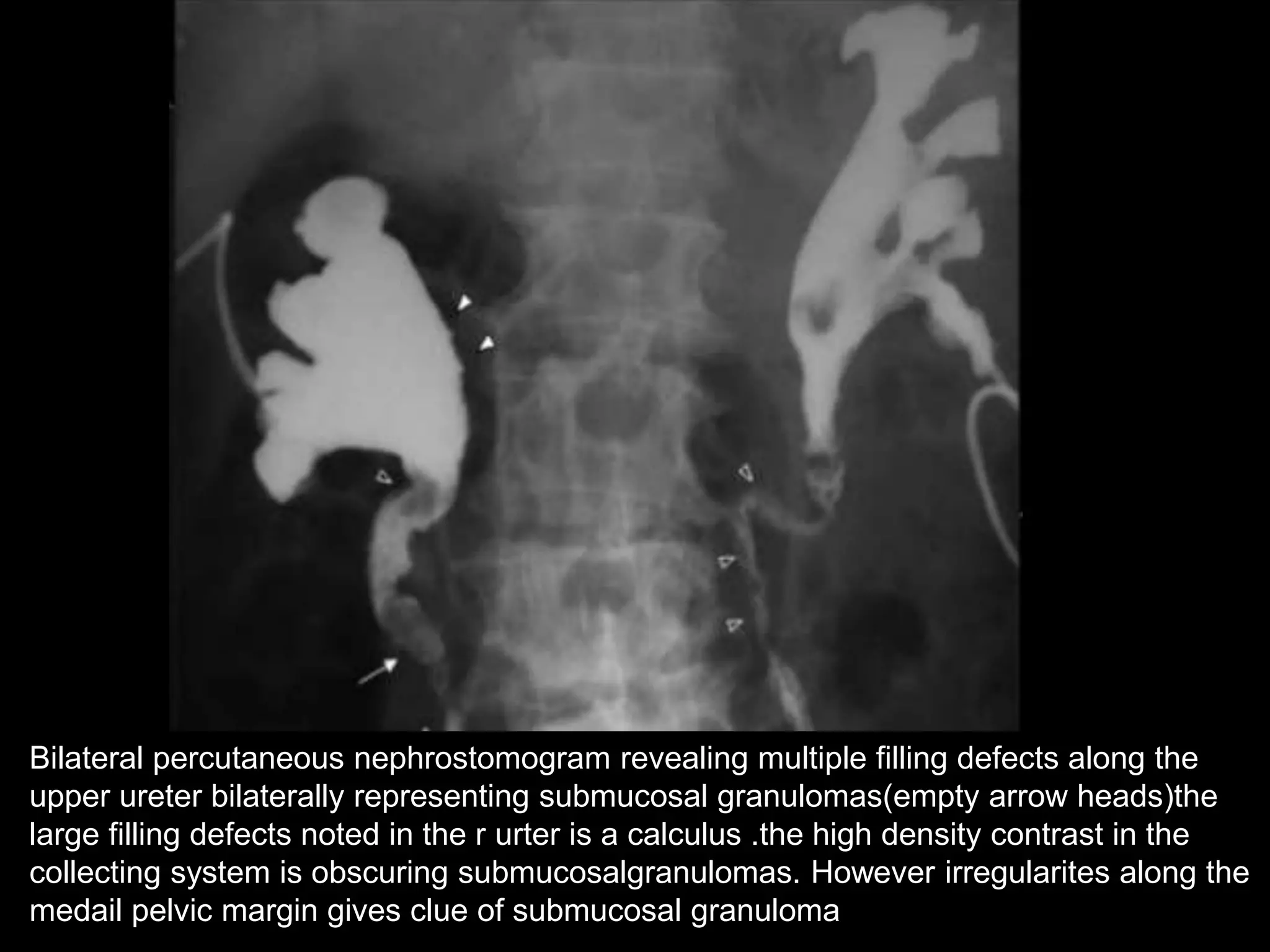 IMAGING FEATURES IN RENAL TUBERCULOSIS | PPTX