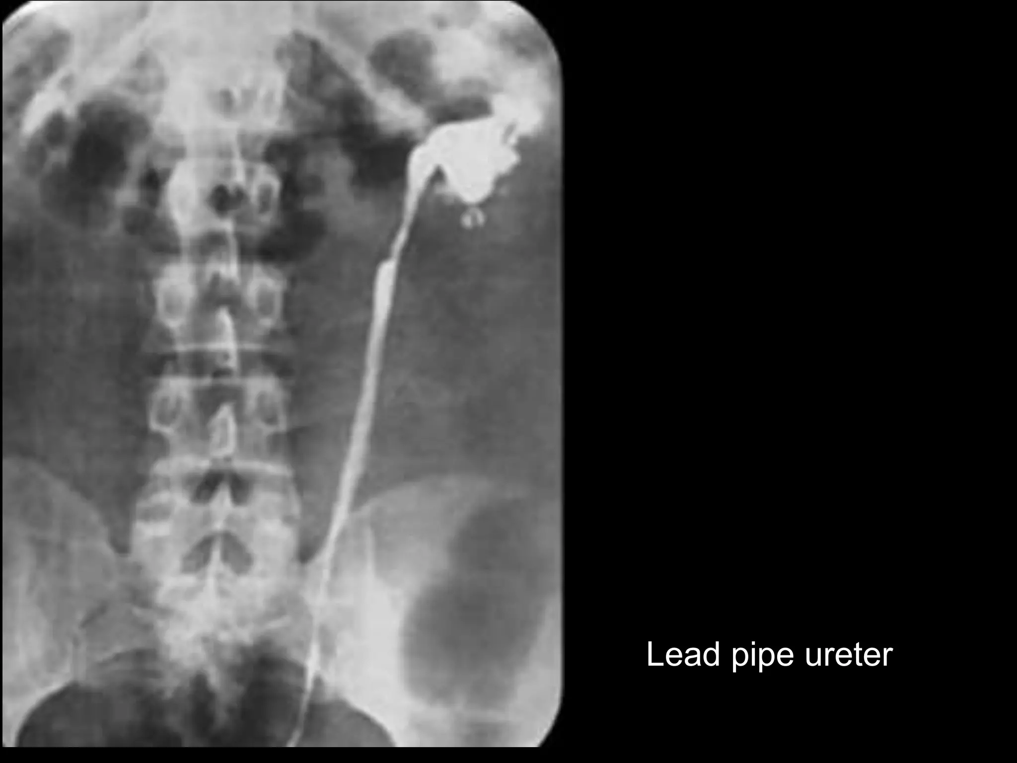 IMAGING FEATURES IN RENAL TUBERCULOSIS | PPTX