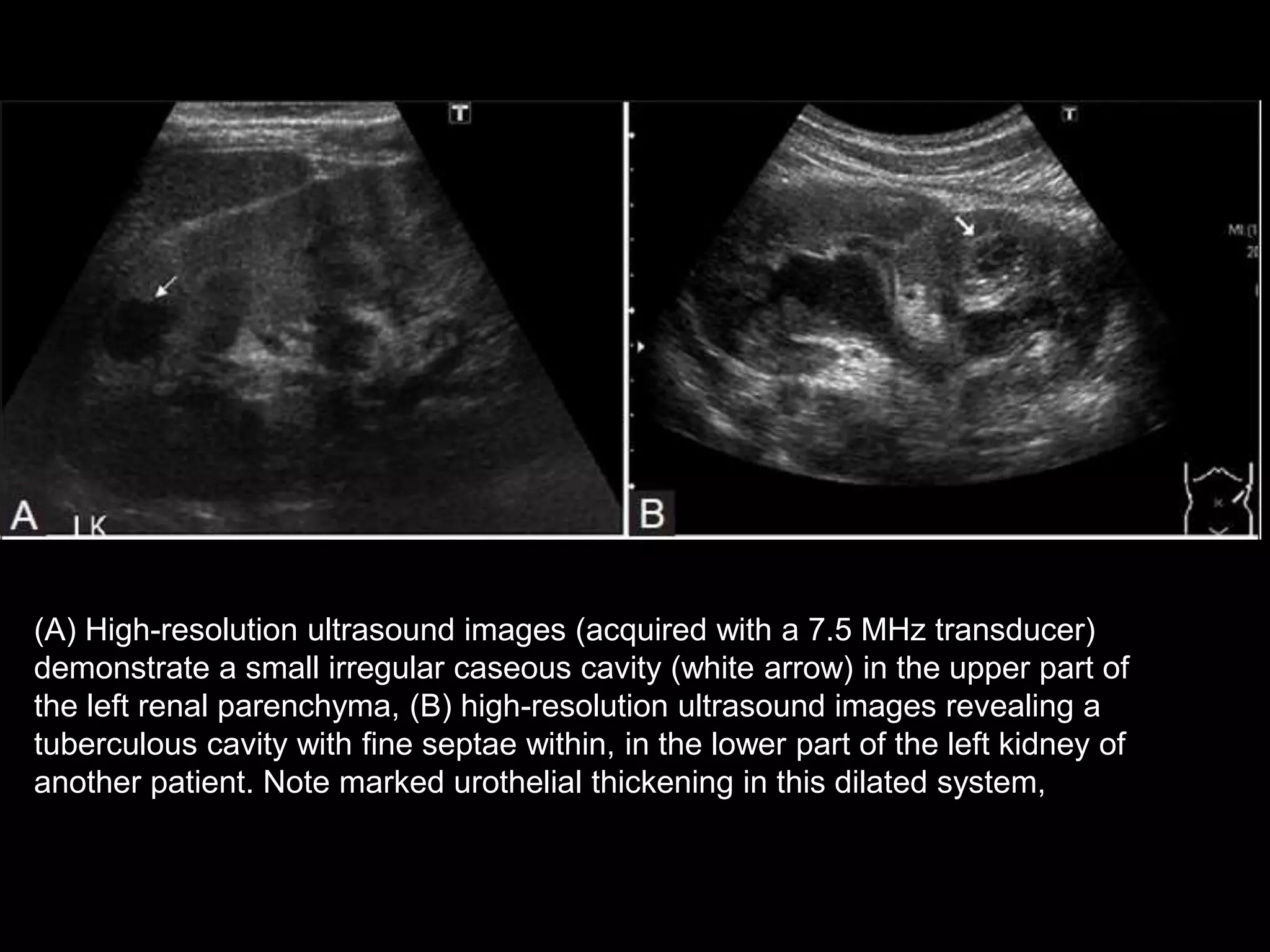 IMAGING FEATURES IN RENAL TUBERCULOSIS | PPTX