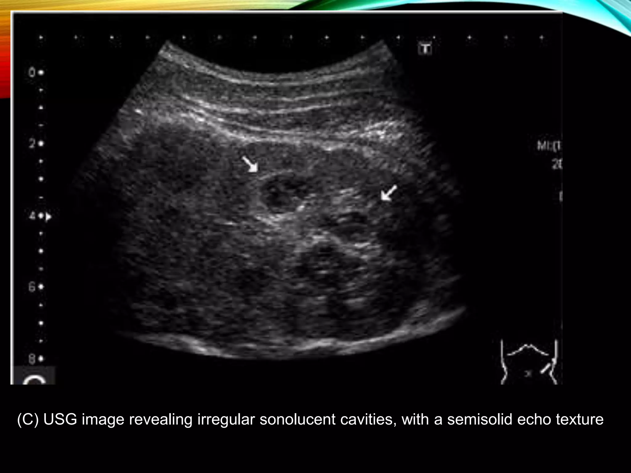 IMAGING FEATURES IN RENAL TUBERCULOSIS | PPTX