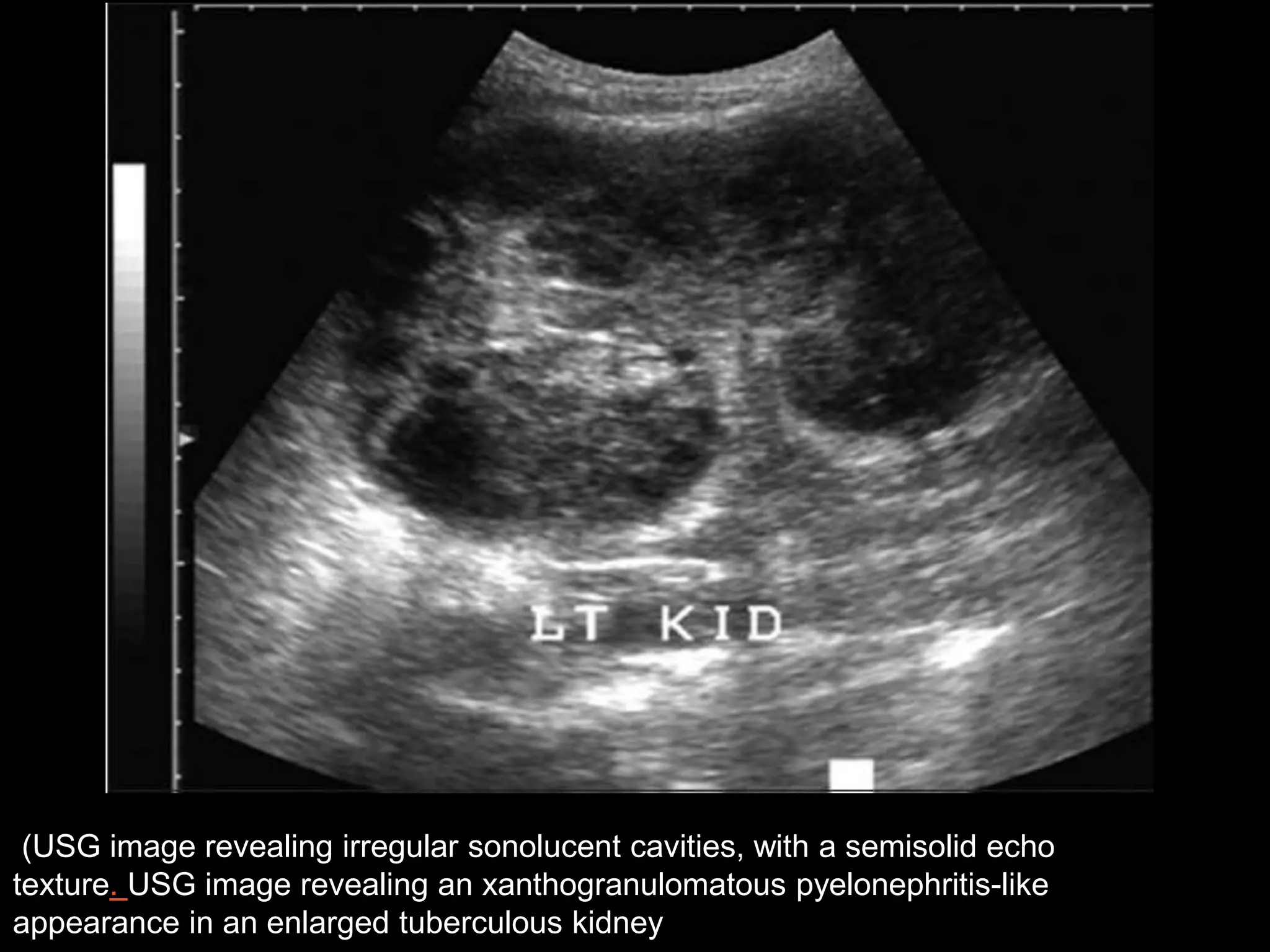 IMAGING FEATURES IN RENAL TUBERCULOSIS | PPTX