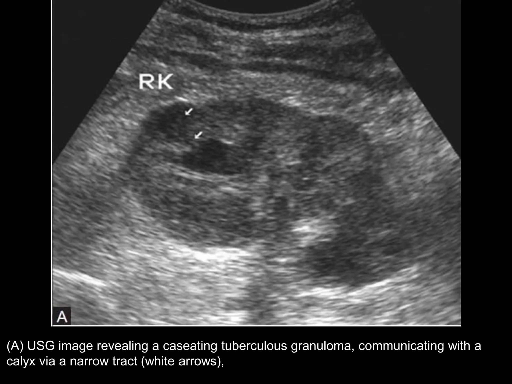 IMAGING FEATURES IN RENAL TUBERCULOSIS | PPTX