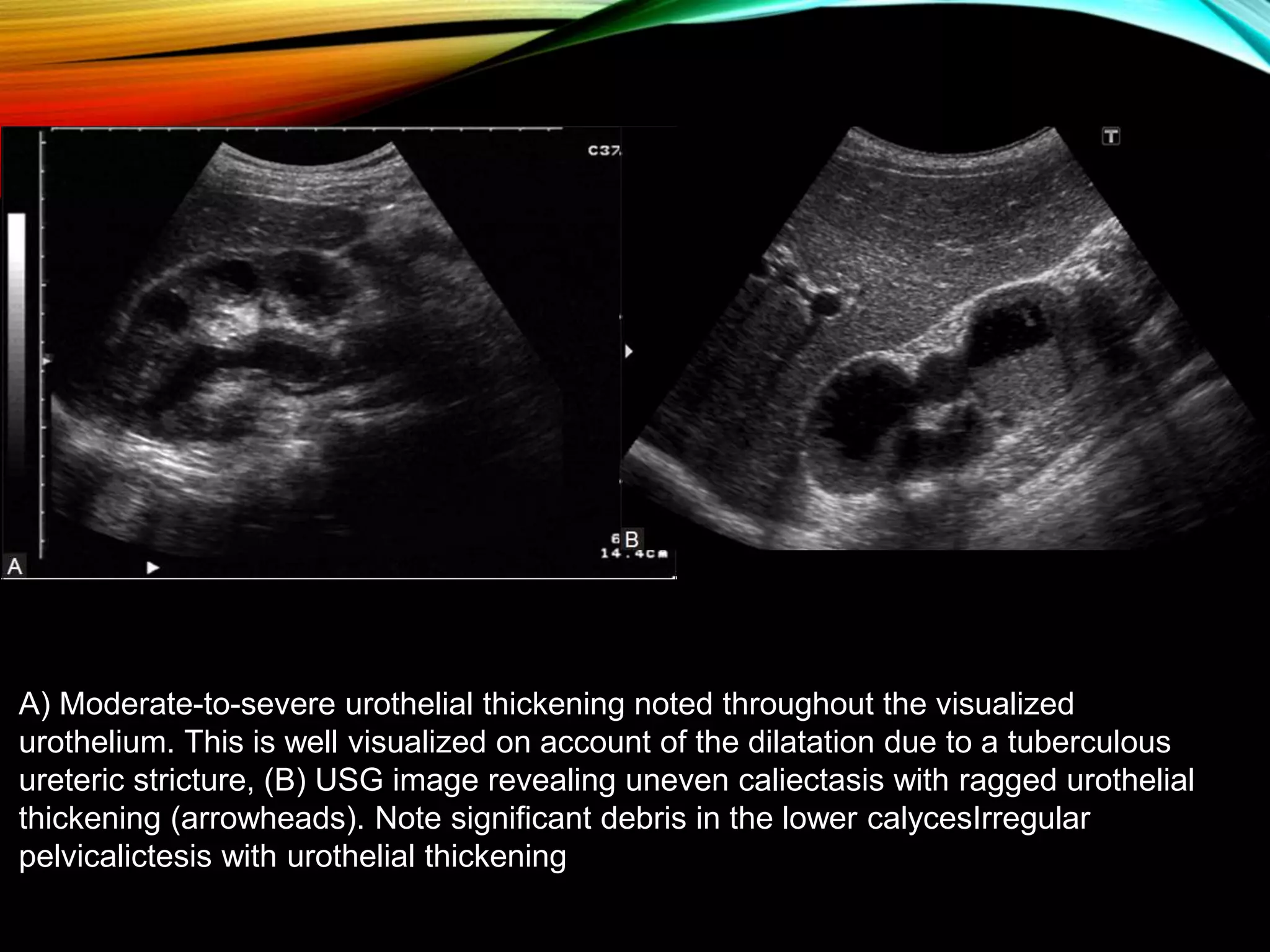 IMAGING FEATURES IN RENAL TUBERCULOSIS | PPTX