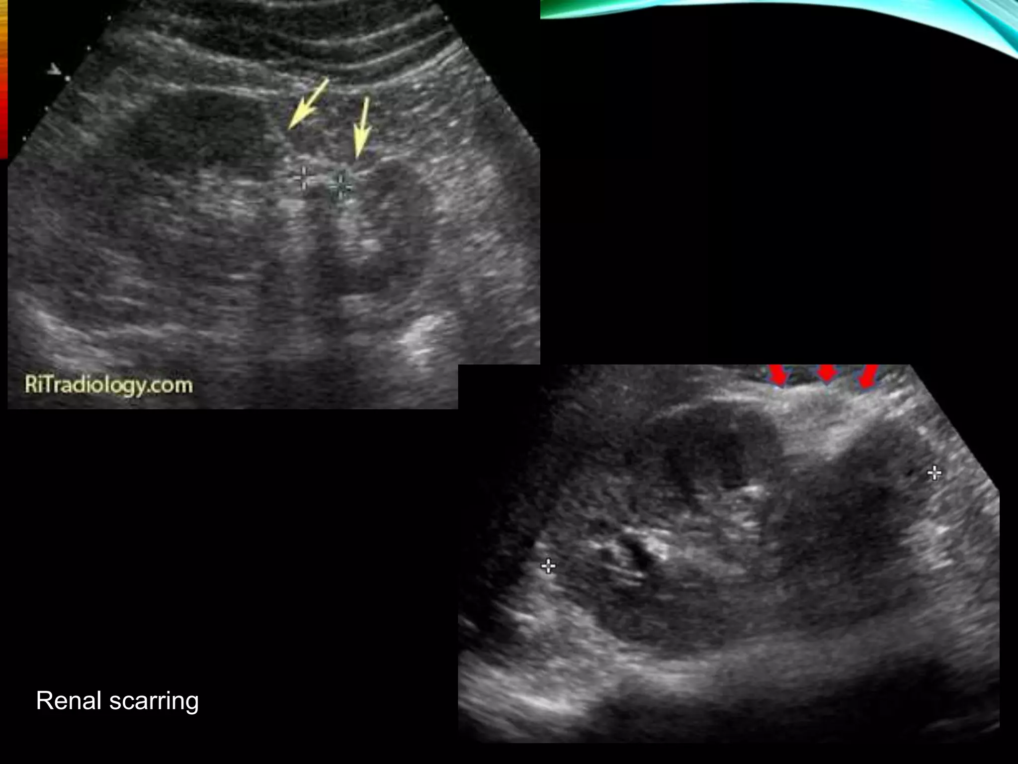 IMAGING FEATURES IN RENAL TUBERCULOSIS | PPTX