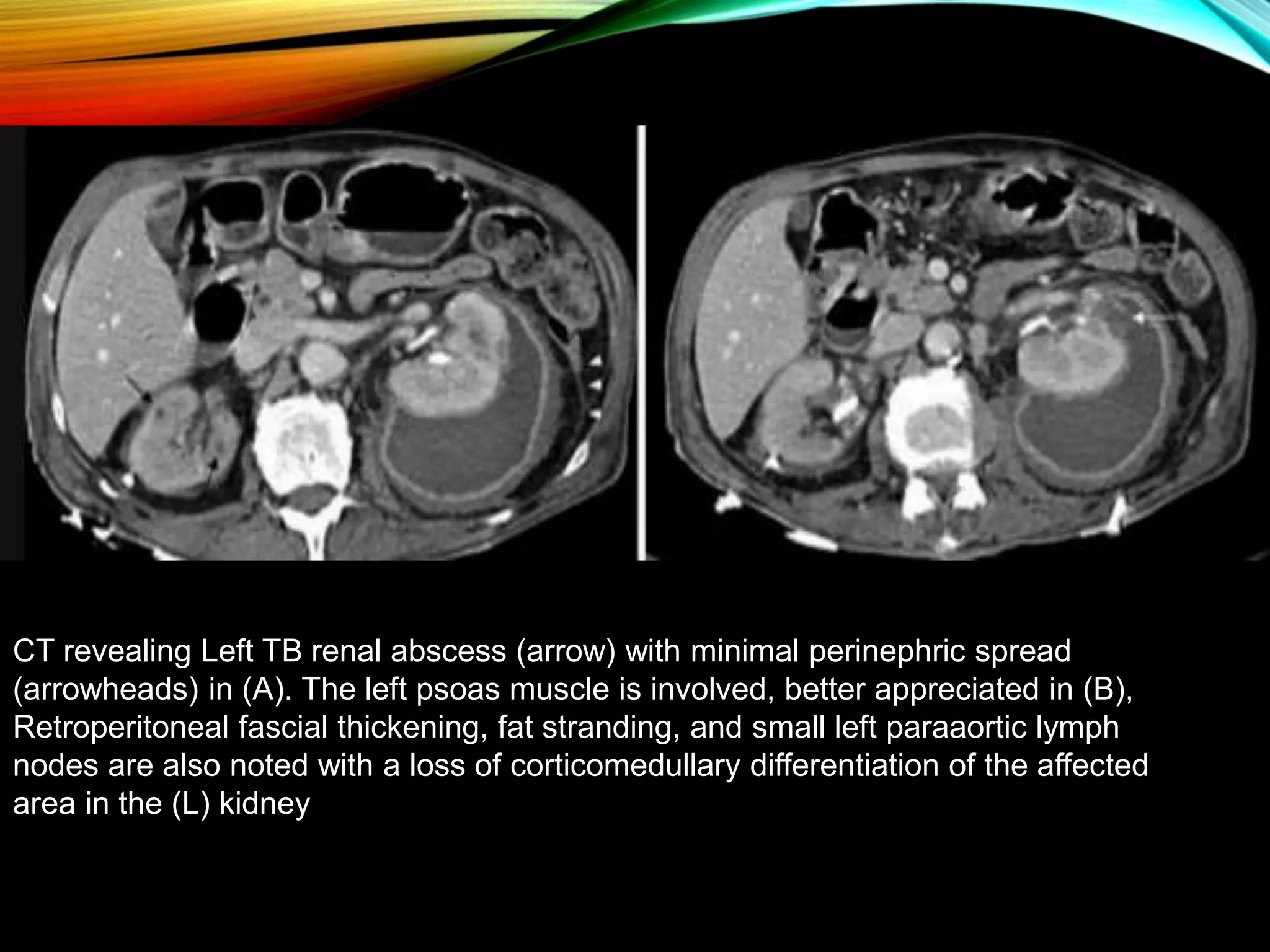 IMAGING FEATURES IN RENAL TUBERCULOSIS | PPTX