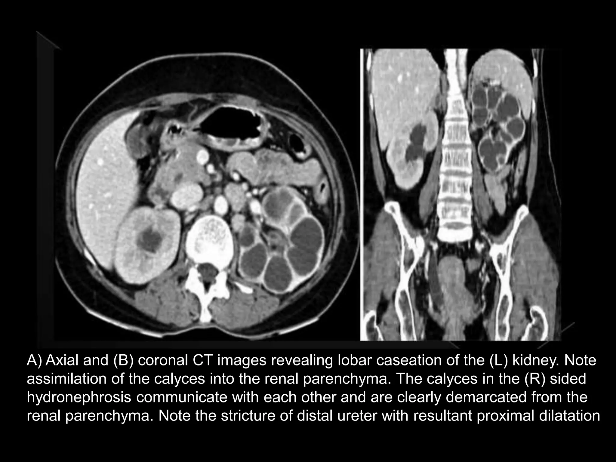 IMAGING FEATURES IN RENAL TUBERCULOSIS | PPTX