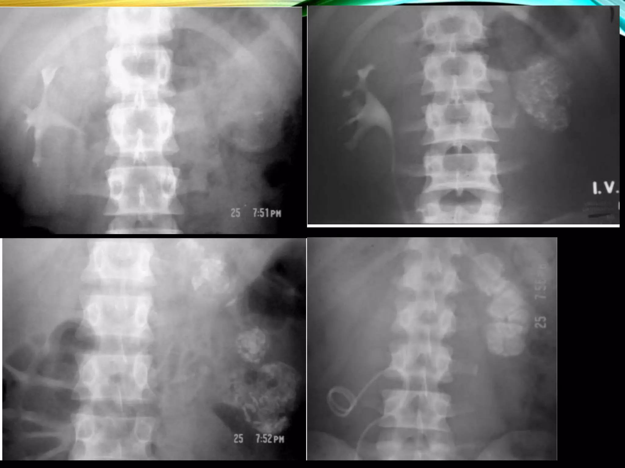 IMAGING FEATURES IN RENAL TUBERCULOSIS | PPTX