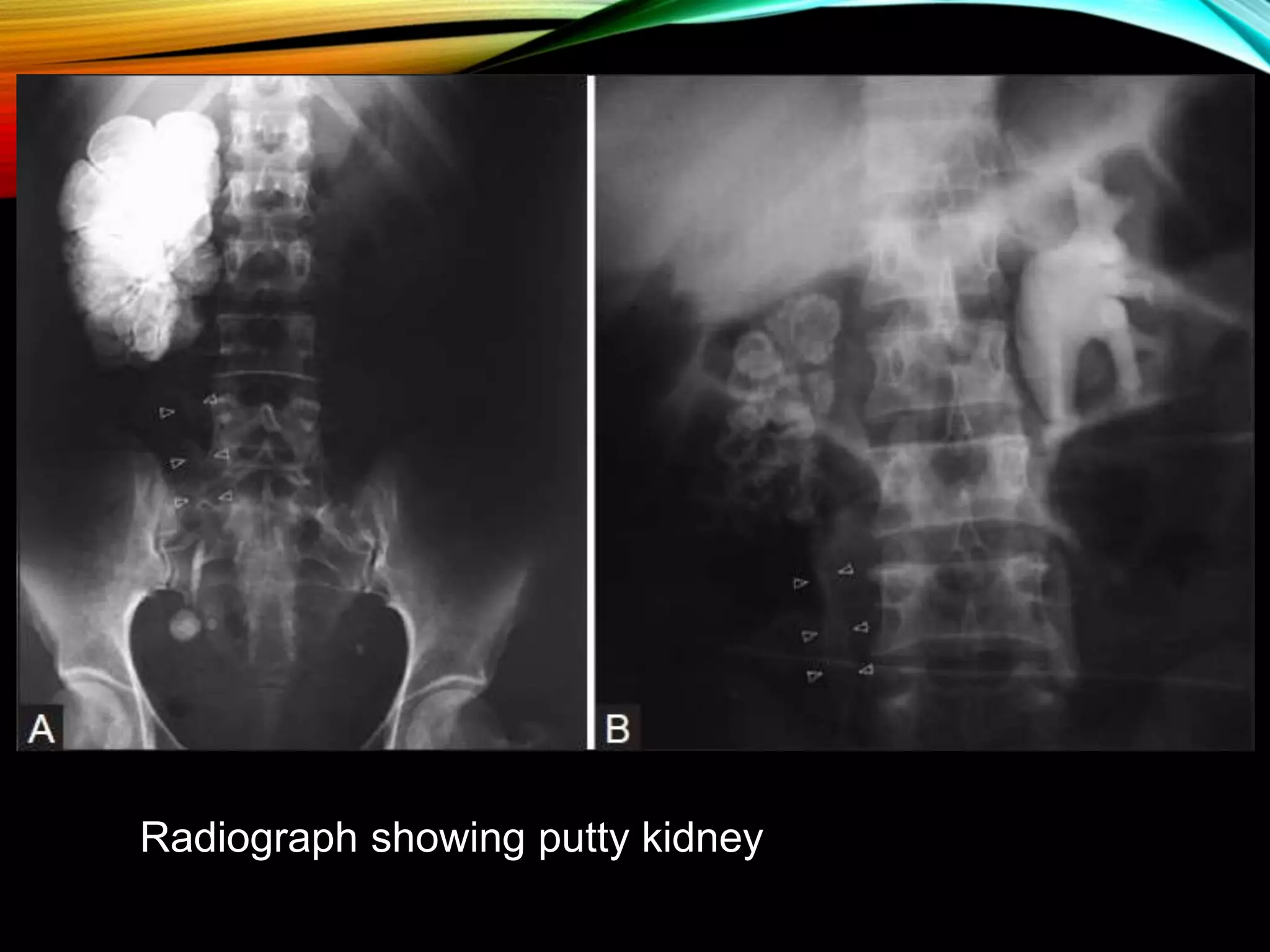 IMAGING FEATURES IN RENAL TUBERCULOSIS | PPTX