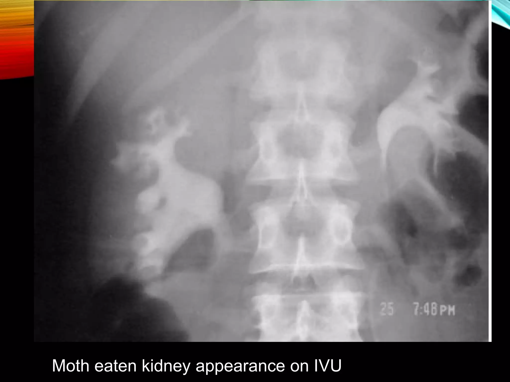 IMAGING FEATURES IN RENAL TUBERCULOSIS | PPTX