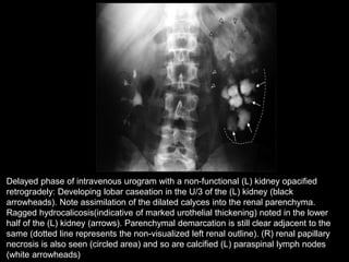 IMAGING FEATURES IN RENAL TUBERCULOSIS | PPTX