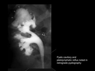 IMAGING FEATURES IN RENAL TUBERCULOSIS | PPTX