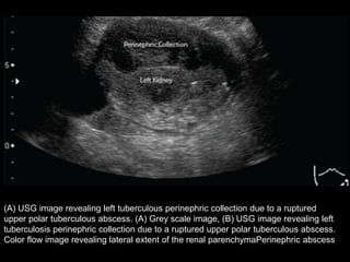 IMAGING FEATURES IN RENAL TUBERCULOSIS | PPTX