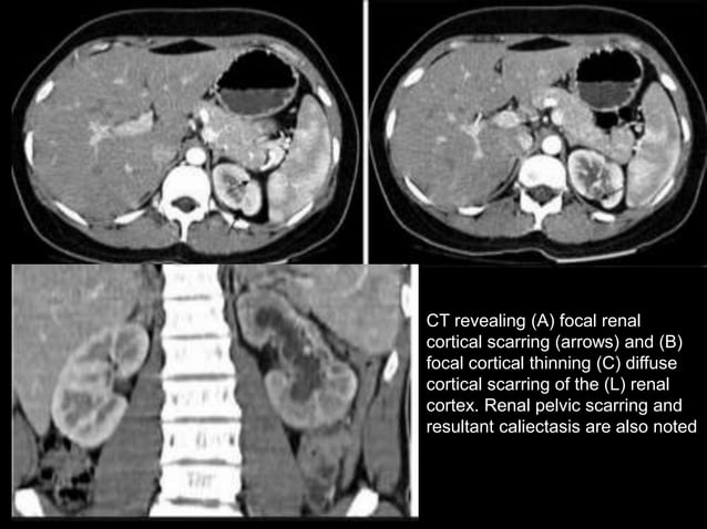 IMAGING FEATURES IN RENAL TUBERCULOSIS | PPTX