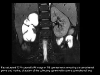 IMAGING FEATURES IN RENAL TUBERCULOSIS | PPTX