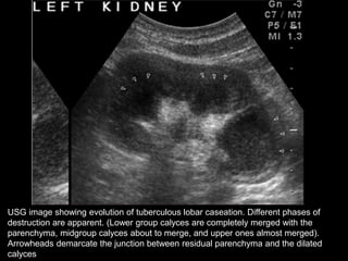 Renal Papillary Necrosis Ultrasound