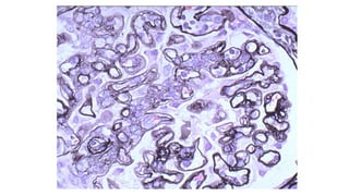 RENAL pathology For post graduates in pathology by Dr. Nancy Gupta pptx ...