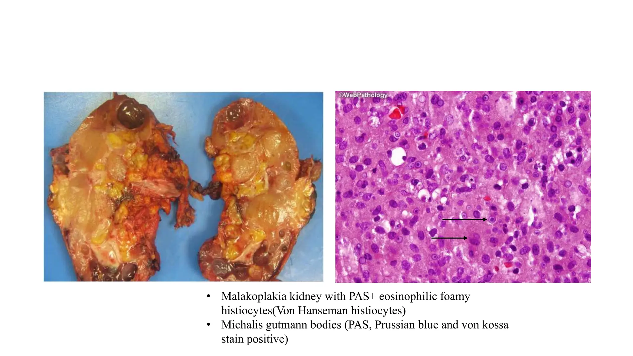 kidney tumors.pptx